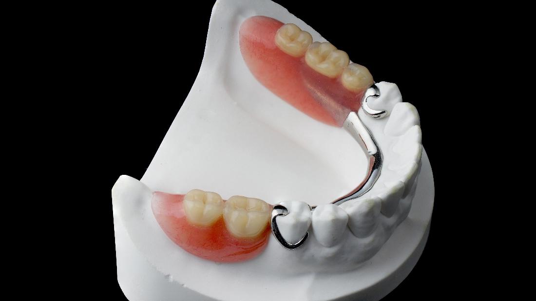 Partial Dentures in Fairfield VIC | Sparkle Dental Care